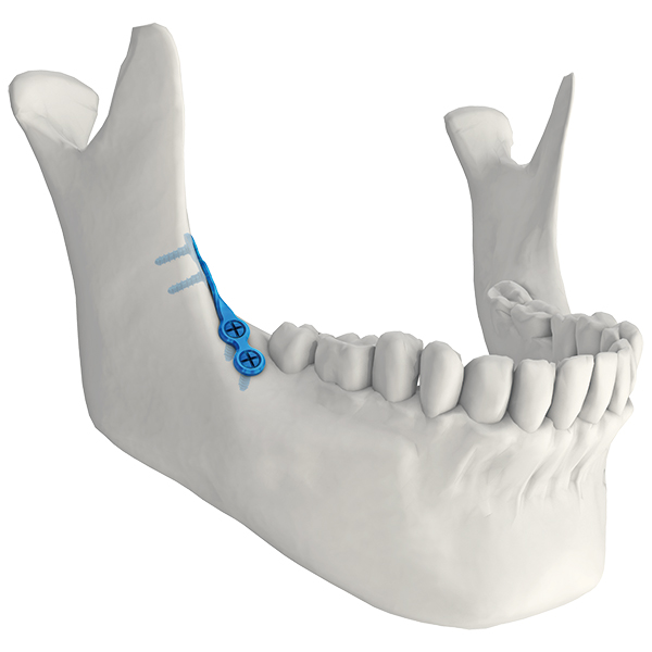 Anatomical Locking Maxillofacial Mini Straight Bridge Plate – Credible ...